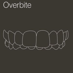 Invisalign in Mississauga, ON | Teeth Straightening Near You